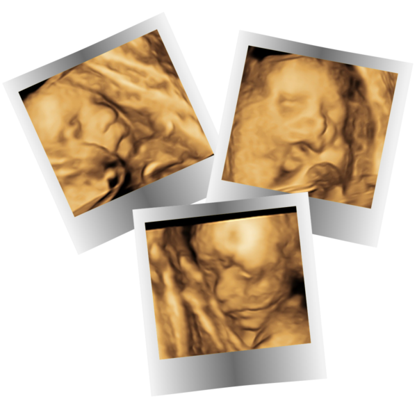 Ecografía 3D-4D - Ecografías Teusa IPS